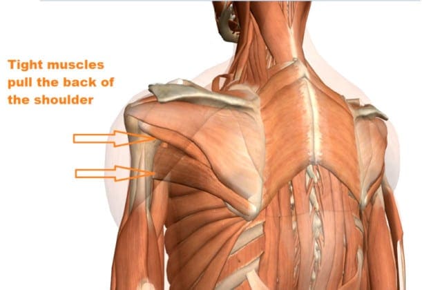 Pulled Shoulder Muscle Injury Chiropractic Care | Sciatica Clinic