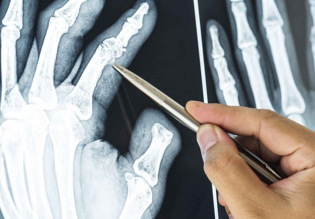 Treating Finger Sprains and Dislocations: An Analysis - El Paso, TX ...